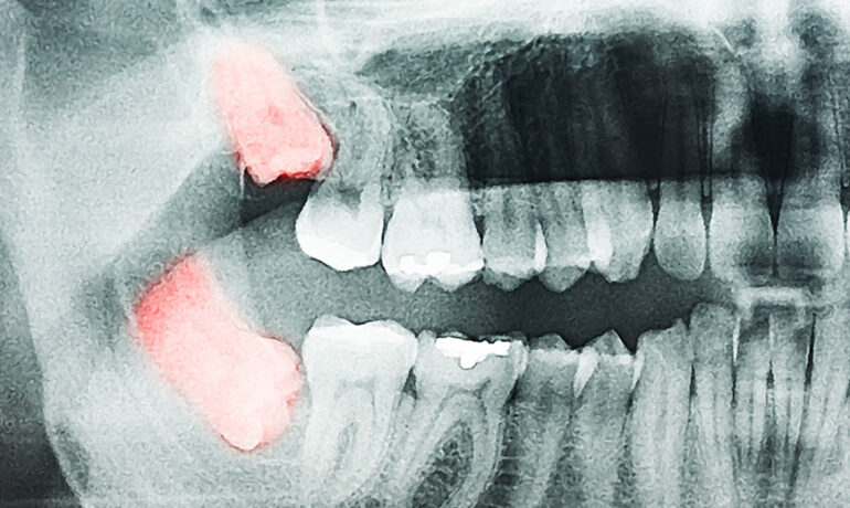 The Importance of Extracting Your Wisdom Teeth: A Wise Decision ...